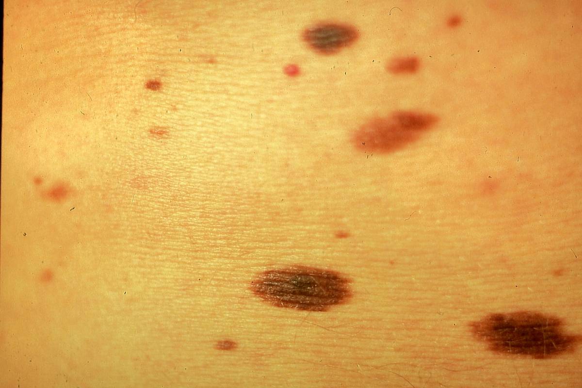 Hautkrebs – Alderma Hautarztpraxis Augsburg